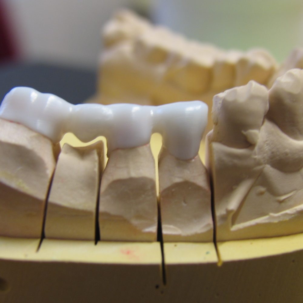 Prothèse conjointe - Laboratoire Denys André - Prothésiste dentaire