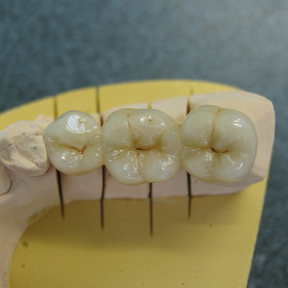 Prothèse conjointe - Laboratoire Denys André - Prothésiste dentaire