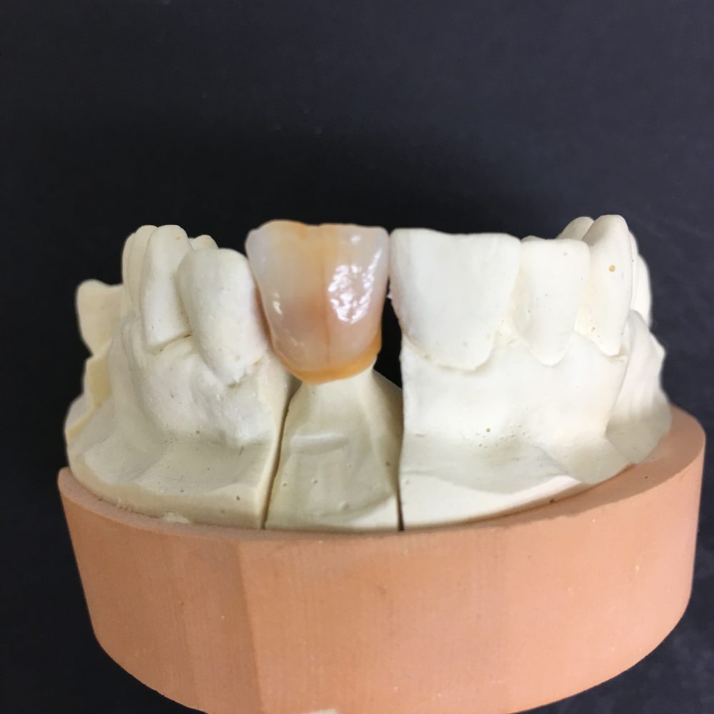 Prothèse conjointe - Laboratoire Denys André - Prothésiste dentaire