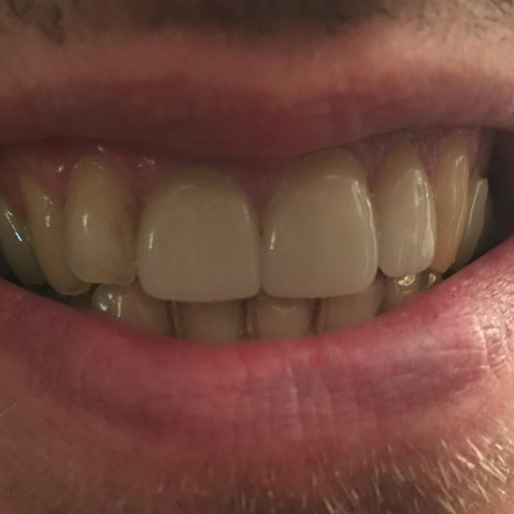 Prothèse conjointe - Laboratoire Denys André - Prothésiste dentaire