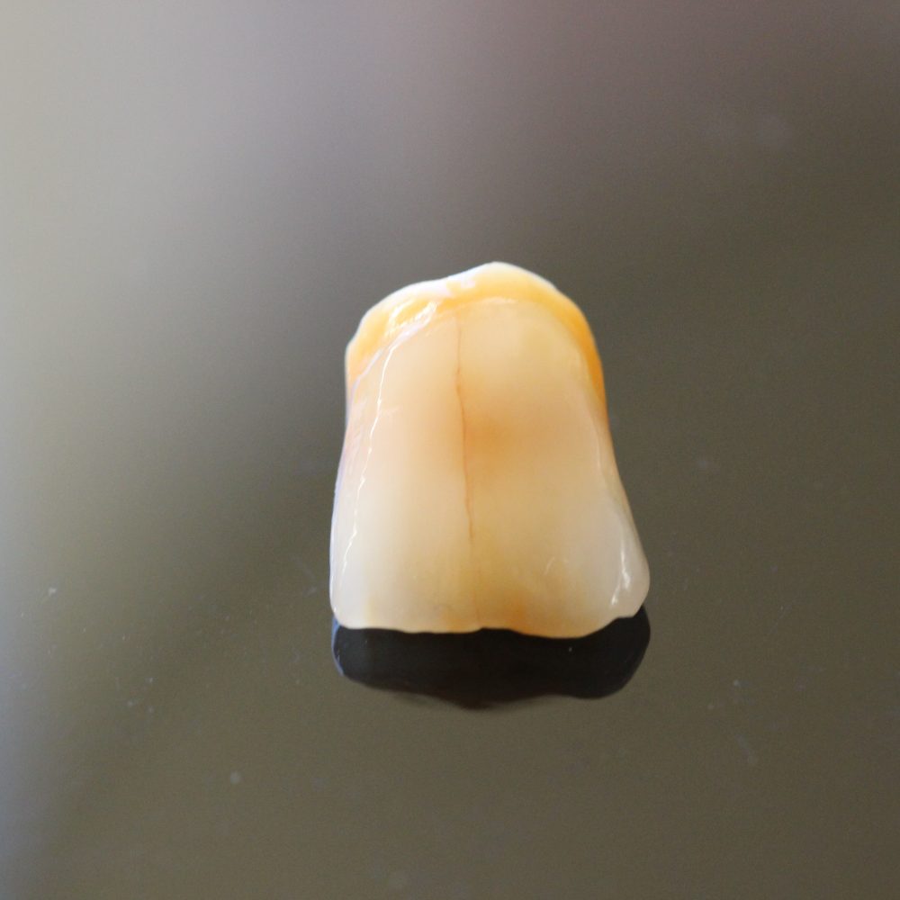 Prothèse conjointe - Laboratoire Denys André - Prothésiste dentaire