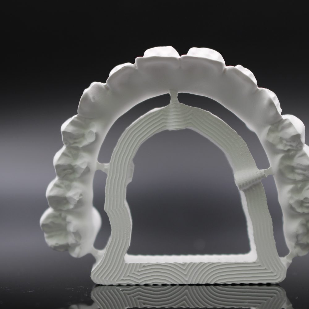 Prothèse conjointe - Laboratoire Denys André - Prothésiste dentaire