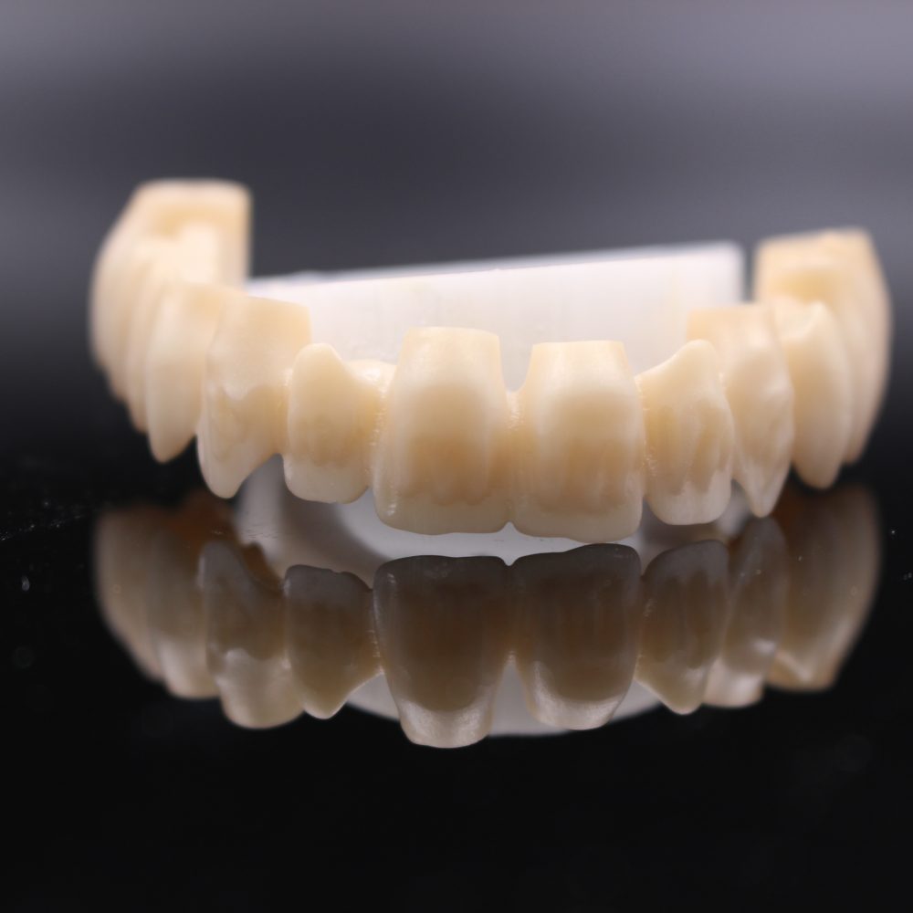 Prothèse conjointe - Laboratoire Denys André - Prothésiste dentaire