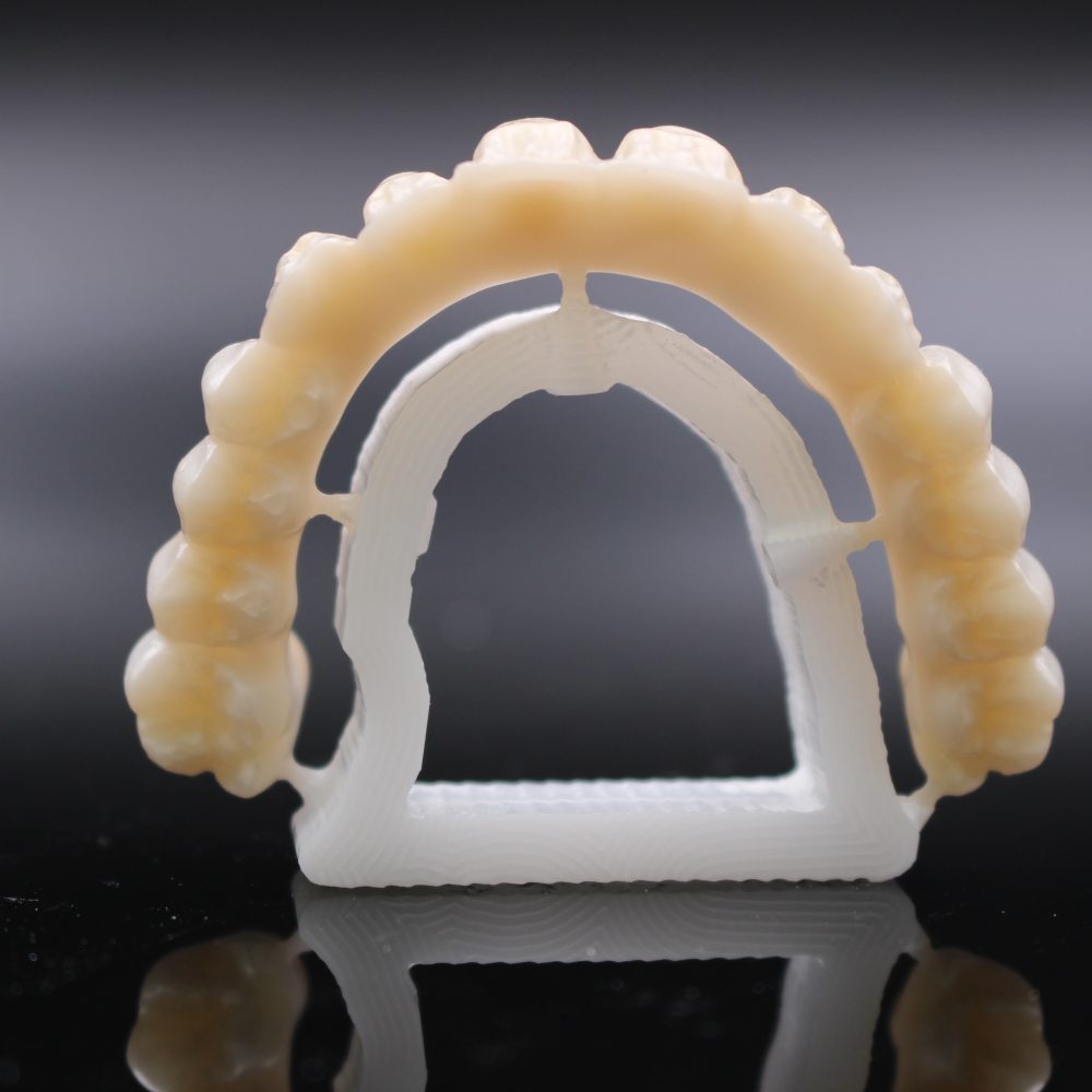 Prothèse conjointe - Laboratoire Denys André - Prothésiste dentaire