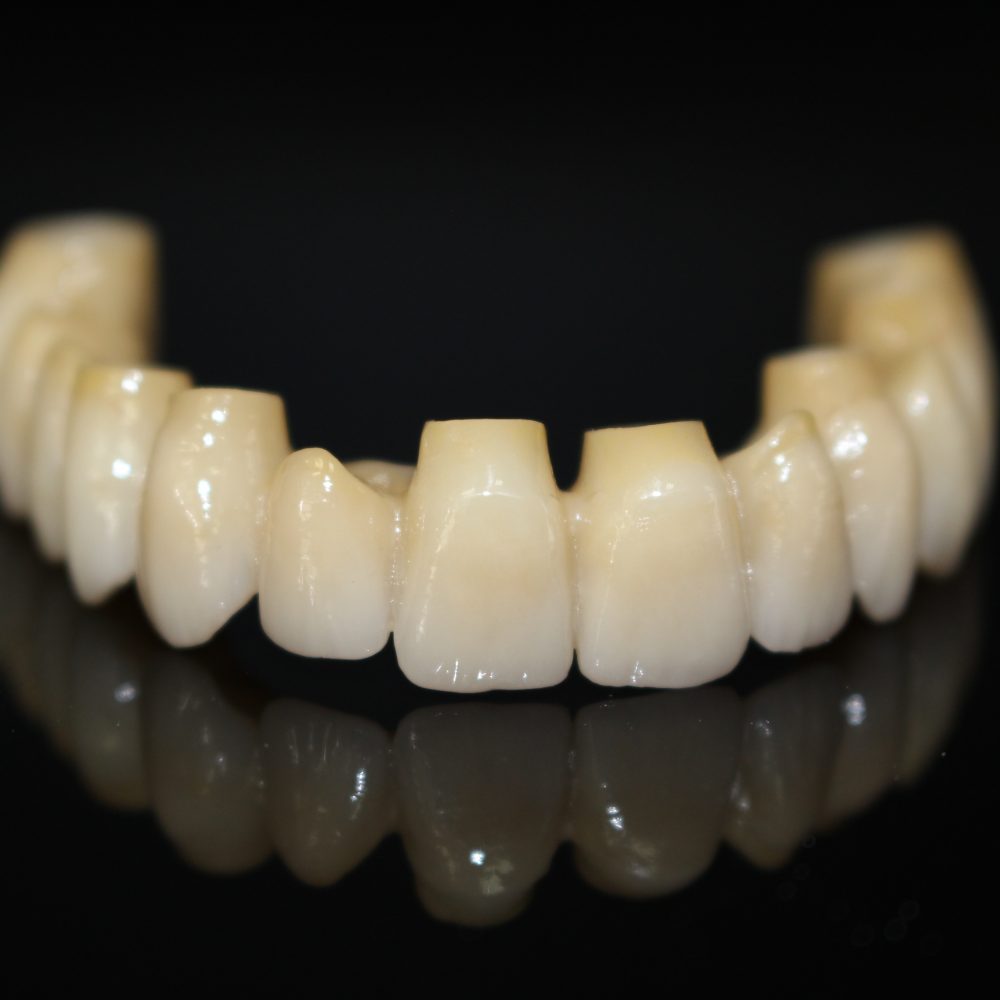 Prothèse conjointe - Laboratoire Denys André - Prothésiste dentaire