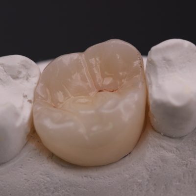 Prothèse conjointe - Laboratoire Denys André - Prothésiste dentaire